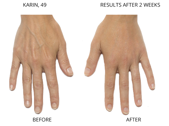 Hand Rejuvenation NYC - Hand Rejuvenation 10128 - Hand Rejuvenation ...