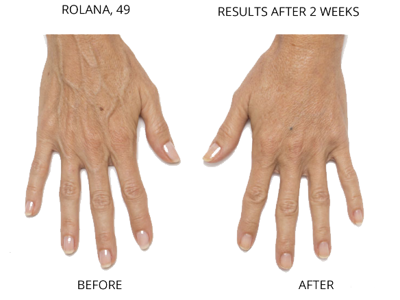 Hand Rejuvenation NYC - Hand Rejuvenation 10128 - Hand Rejuvenation ...