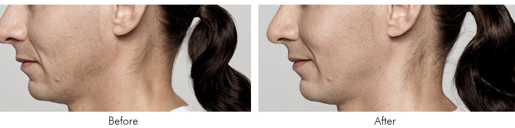 Restylane Lyft Before & After Pictures - Dr. Richard Swift, MD