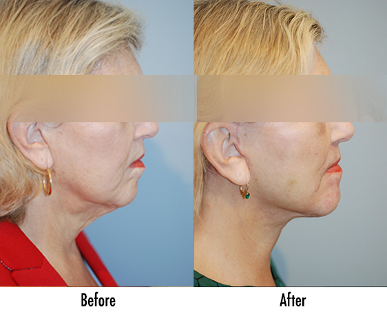 Facial Surgery in Manhattan, NYC – Best Facial Surgery NYC – Best ...