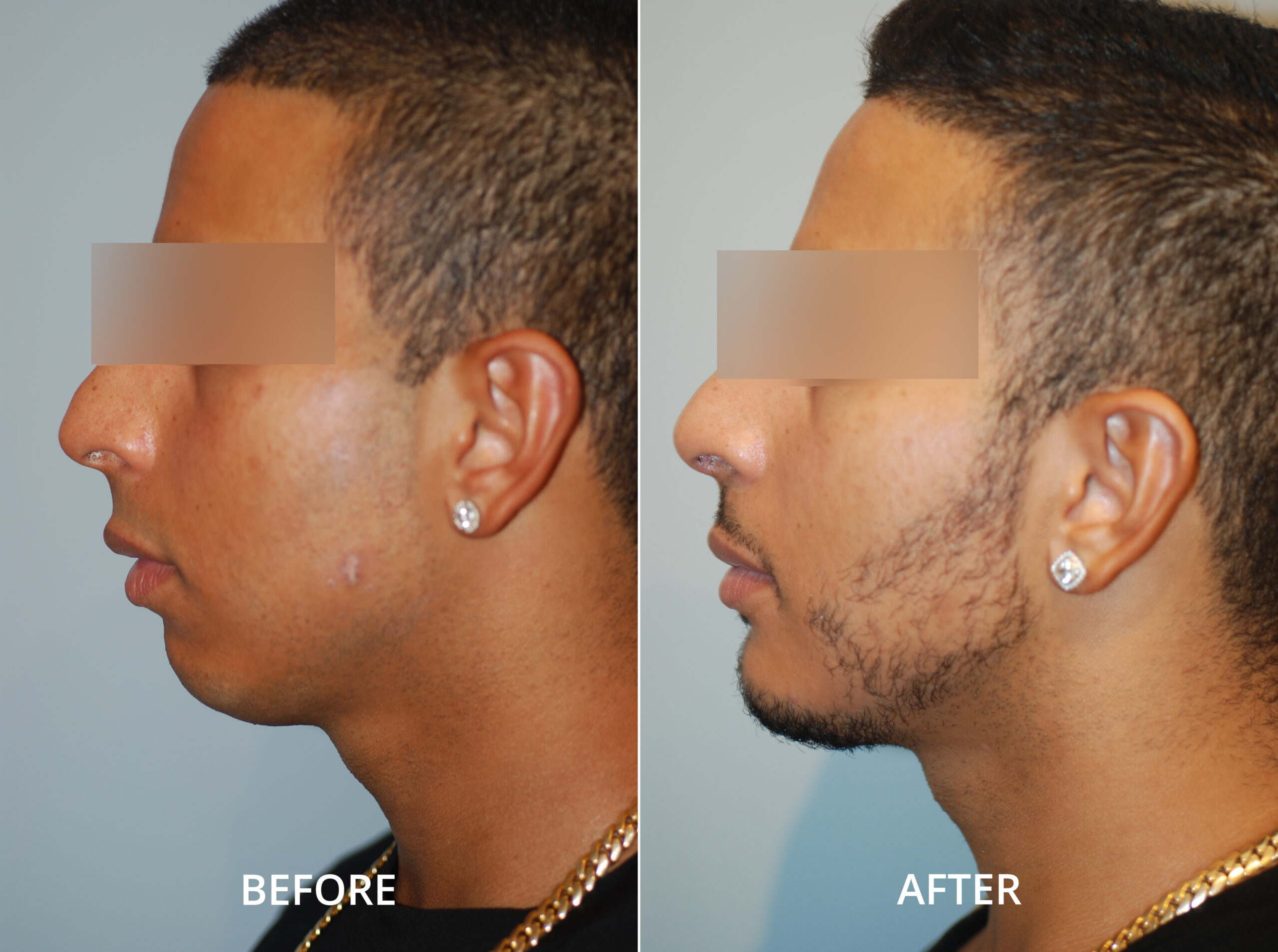 Chin Implants NYC - Chin Implant Midtown – Chin Augmentation Surgery ...
