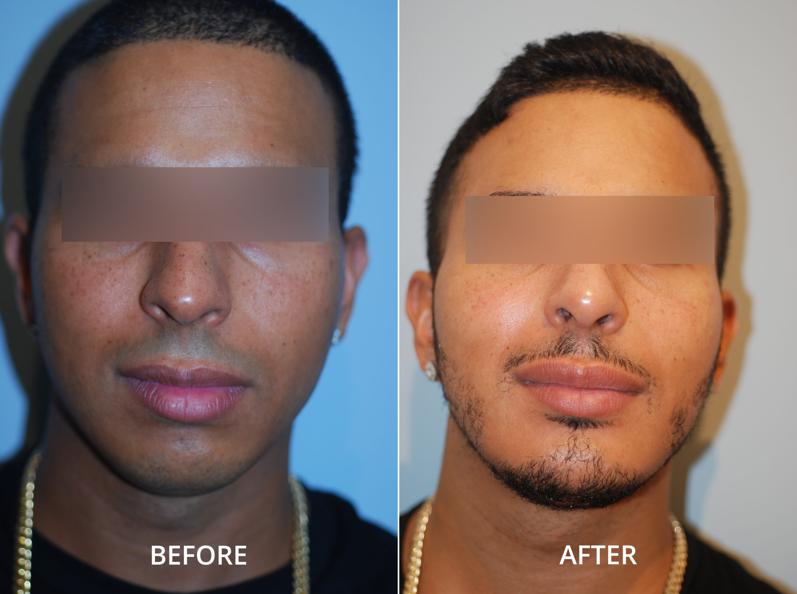 Chin Implants NYC - Chin Implant Midtown – Chin Augmentation Surgery ...